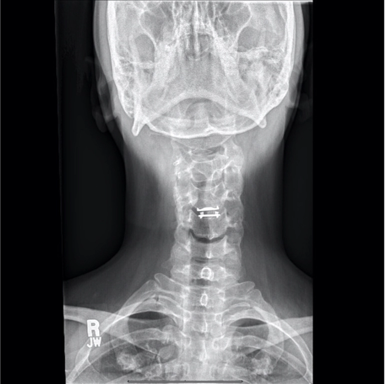 Mobi-C Artificial Cervical Disc Replacement | Wascher Spine Institute