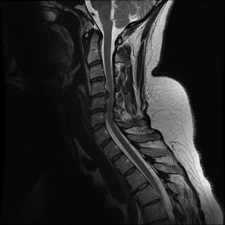 Mobi-C Artificial Cervical Disc Replacement | Wascher Spine Institute